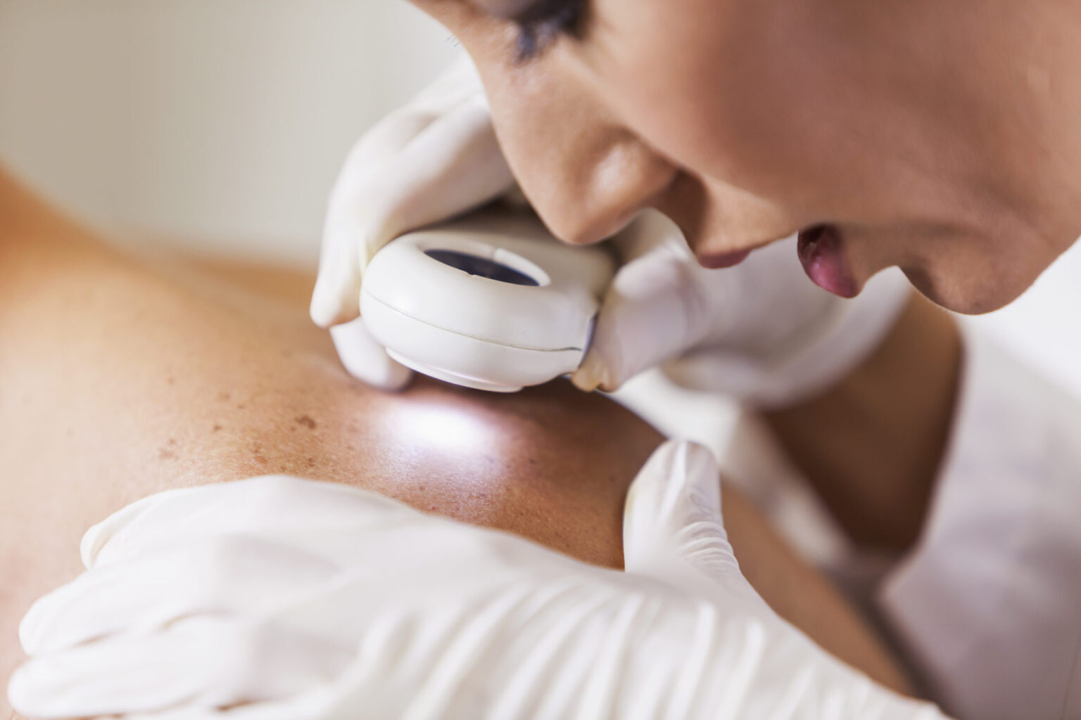 Mole Removal | Aspen Facial Plastic Surgery