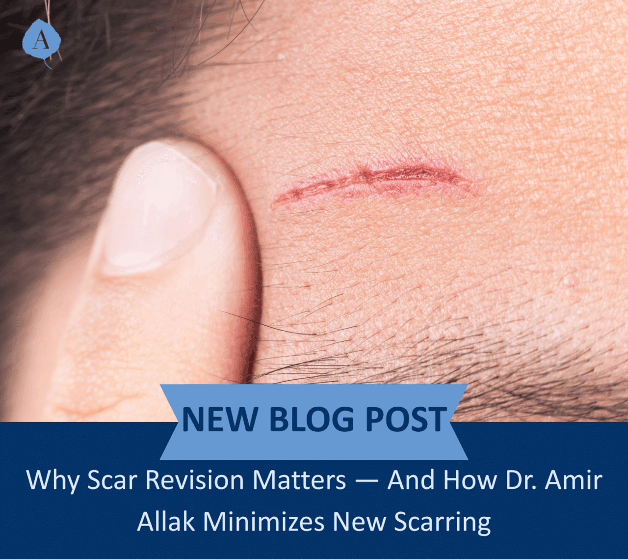 Scar Revision in Utah | Dr. Amir Allak | Aspen Facial Plastics
